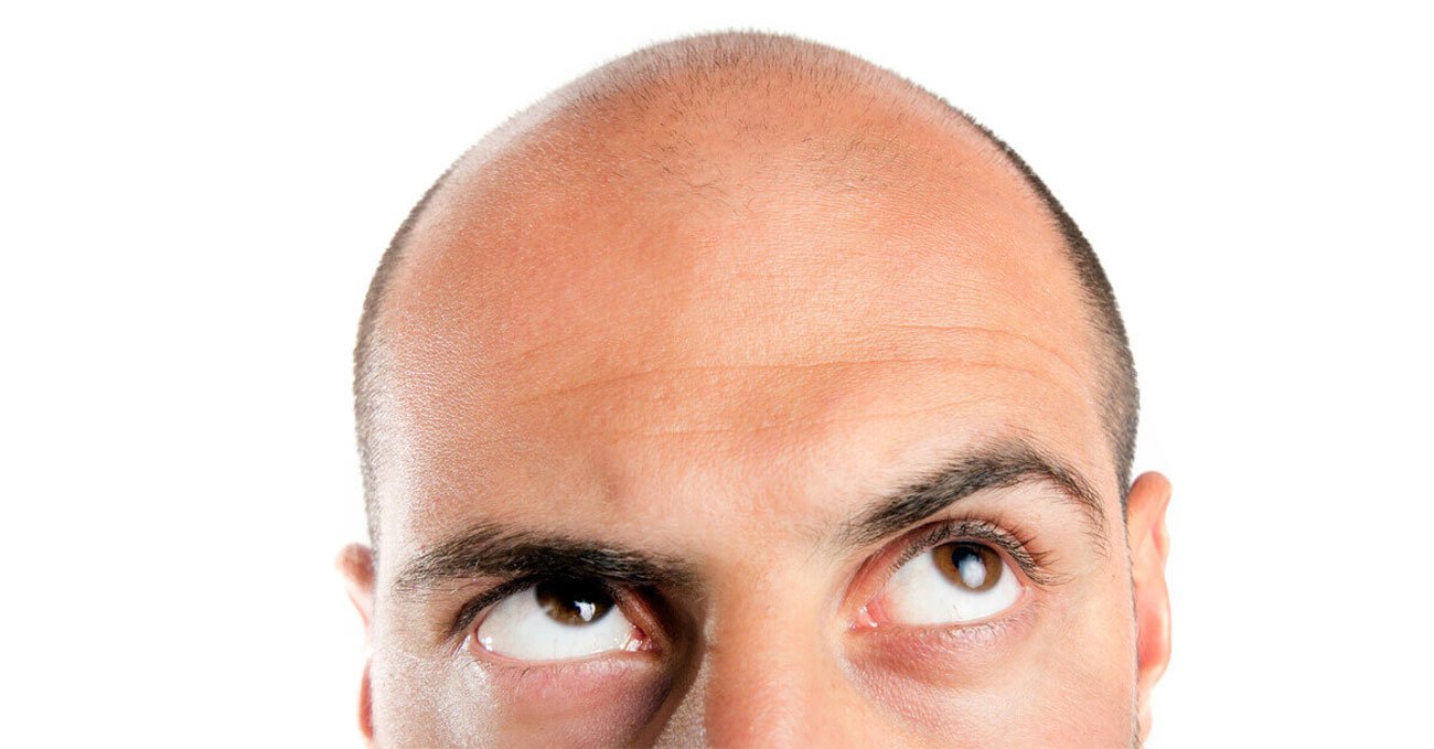 Calvície masculina? Veja tudo o que você precisa saber | Exame